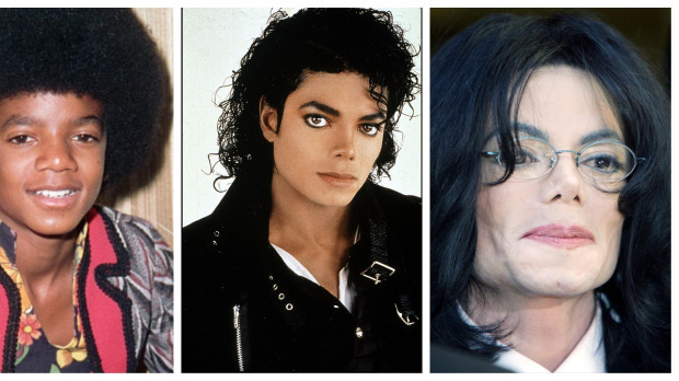 vitiligo michael jackson