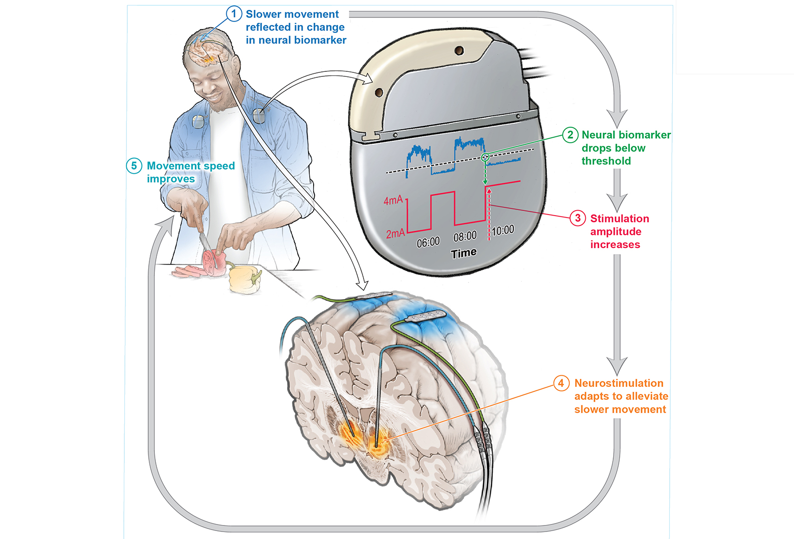 Así funciona el marcapaso cerebral inteligente que controla el párkinson